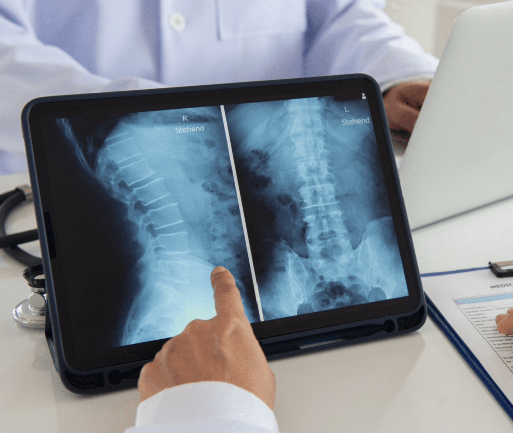What is XLIF Spine Surgery and Is It Right for Me? | Santa Rosa ...
