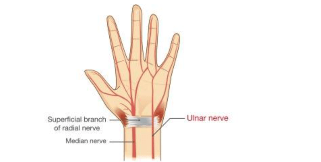 What is Ulnar Tunnel Syndrome of the Wrist? | Santa Rosa Orthopaedics